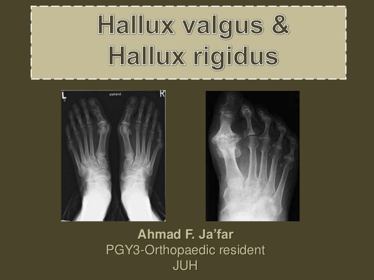 hallux valgus & hallux rigidus