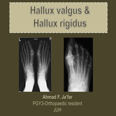 hallux valgus & hallux rigidus | PPTX