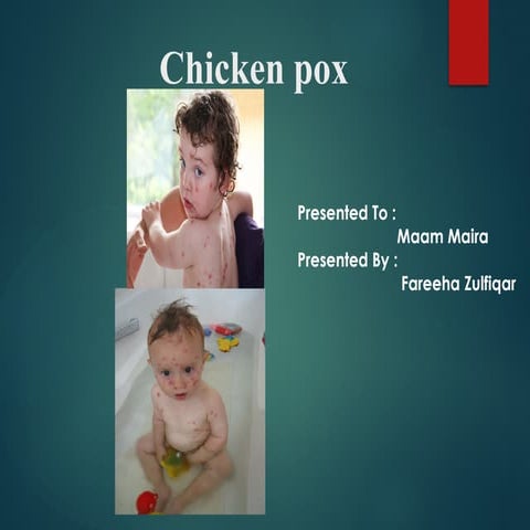 Chickenpox: Pathophysiology | PPTX