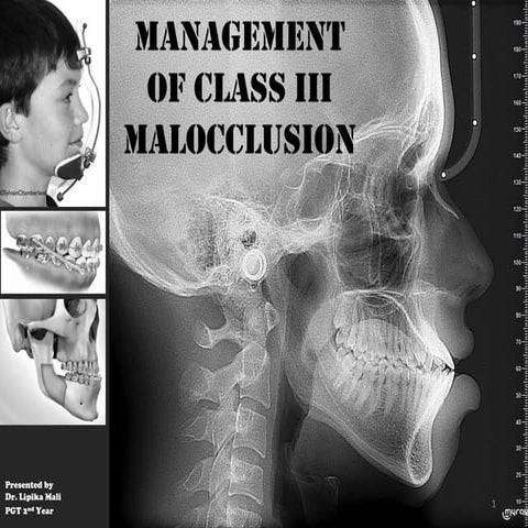 Orthodontic-Class-III-Management .pptx