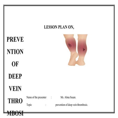 Homan’s Sign for DVT.pptx