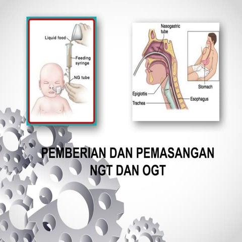 prosedur pemasangan nasogastric tube dan OGT | PPTX