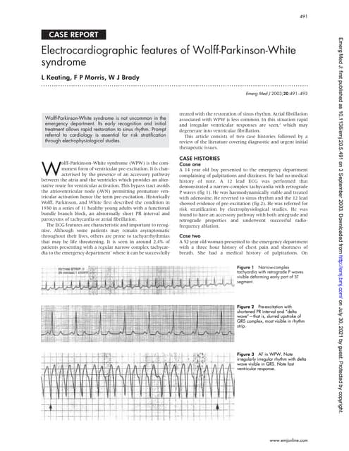 P wave abnormalities in ECG | PPSX | Heart and Cardiovascular Diseases | Diseases and Conditions