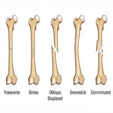 The different types of bone fracture | PDF
