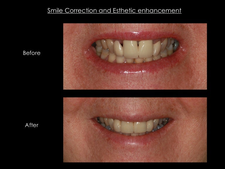 Smile Correction and Esthetic Enhancement