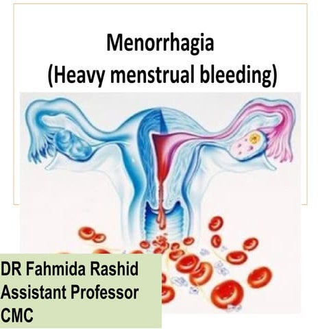 Menorrhagia(For undergraduate MBBS) | PPT