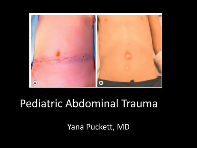 Abdominal trauma