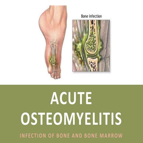 Aetiology, pathology and management of osteomyelitis | PPTX