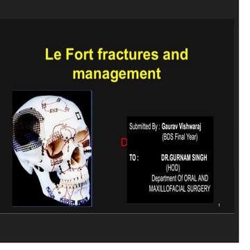 Le Fort Fractures | PPT