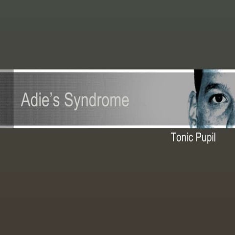 Adie’s Syndrome Focus Presentation.ppt