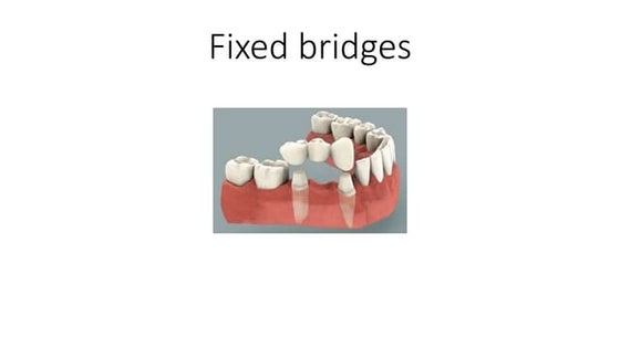 Dental Bridges And It's Types Explained Simply | PPTX