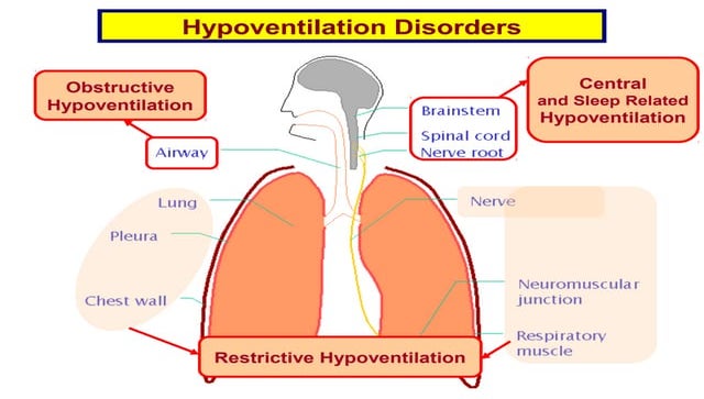 Obesity Hypoventilation Syndrome | PPT