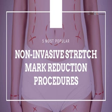 5 Most Popular Non-Invasive Stretch Mark Reduction Procedures | PPTX