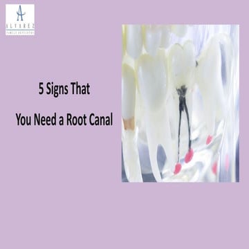 5 Signs That You Need a Root Canal-Alvarez Family Dentistry | PPT