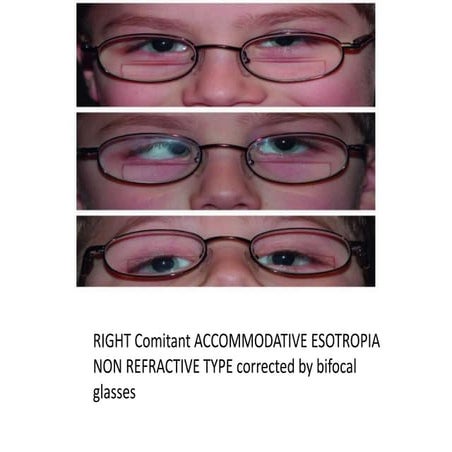 ophthalmology photos for disease and abnormality | PPT