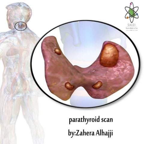 parathyroid scan | PPT