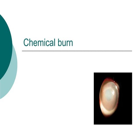 Chemical-burn | PPT | Eye and Vision Conditions | Diseases and Conditions