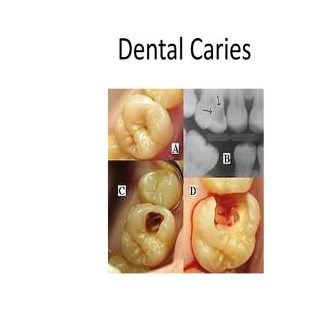Oral pathology chapter 6 Dental caries.pptx