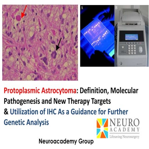 Protoplasmic Astrocytoma: Definition, Molecular Pathogenesis and New ...