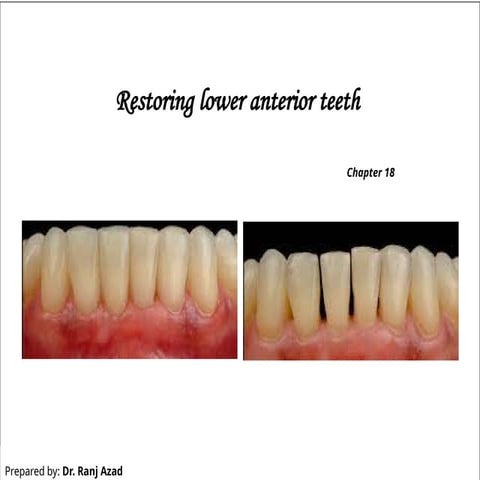 Comprehensive Guide to Restoring Lower Anterior Teeth: Positioning ...