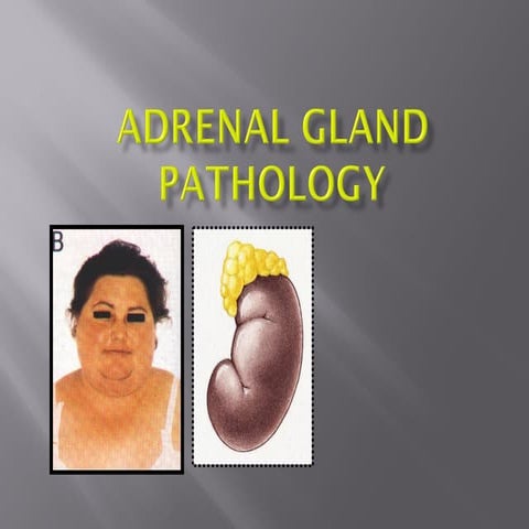 6 The Adrenal gland pathology lecture.ppt