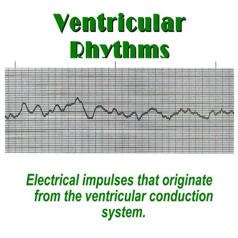 Ventricular Rhythms - BMH/Tele | PPT