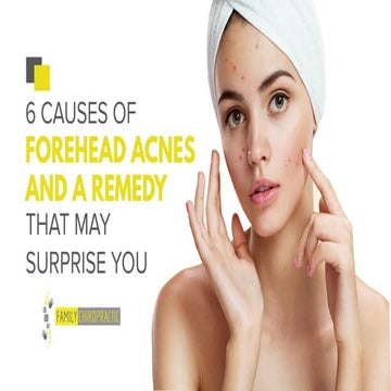 6 Causes Of Forehead Acnes And A Remedy That May Surprise You | PPT