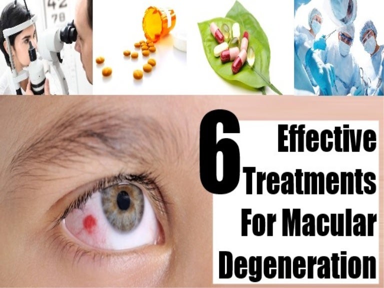 6 Effective Treatments For Macular Degeneration 6-effective-treatments-for-macular-degeneration