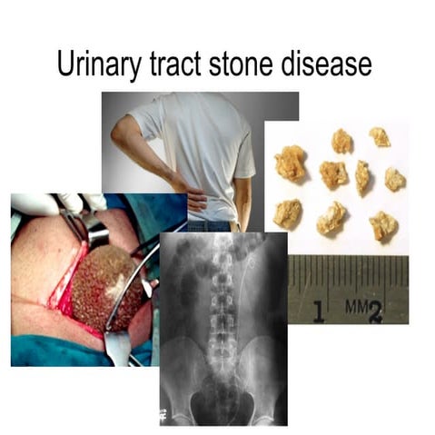 6 Urolithiasis.pdf, Kidney stones and the infections | PPT