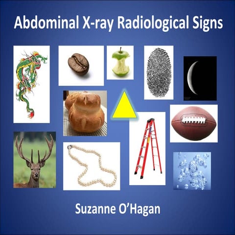 Signs of Pneumoperitoneum on Plain Film | PPTX