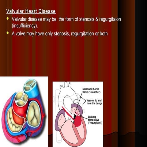 7.Valvular heart disease pathology | PPT