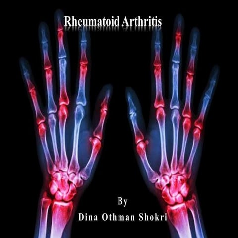 Rheumatoid arthritis | PPT