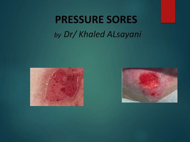 Pressure sore or bed sore or decubitus ulcer ppt | PPTX