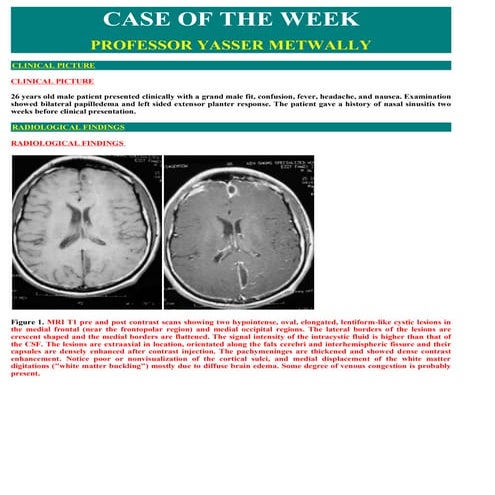 Case record...Subdural empyema | PDF