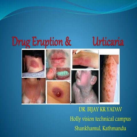 8. Drug eruption & urticaria | PPTX
