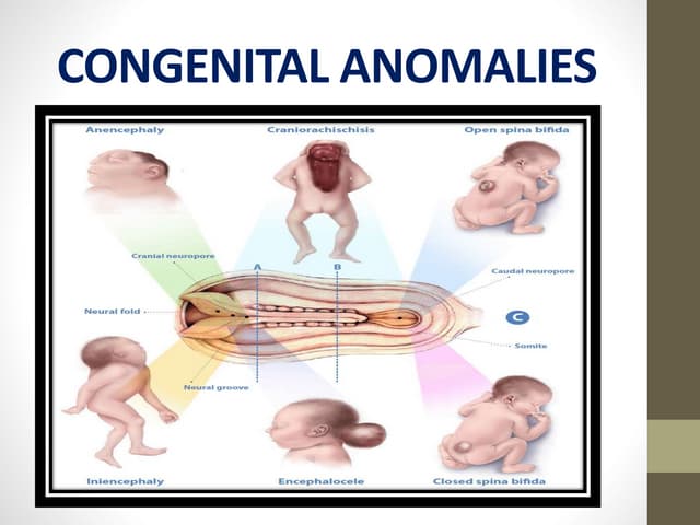 8 Congenital Anomalies Ppt Orthopedic Nursing Pptx