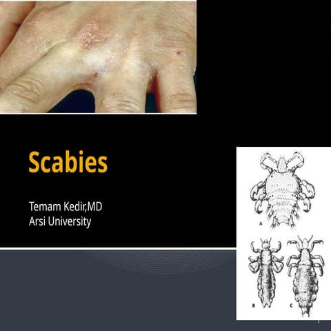 Scabies lecture.pptx