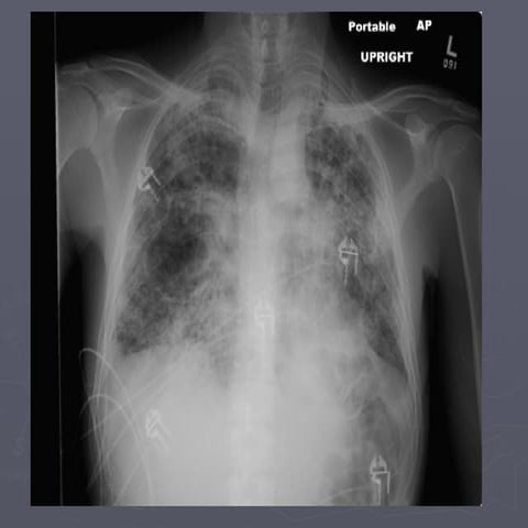 Extrapulmonary tuberculosis | PPT