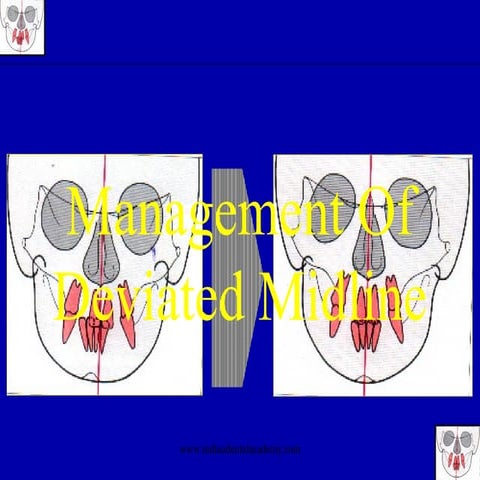Management of deviated midline | PPT