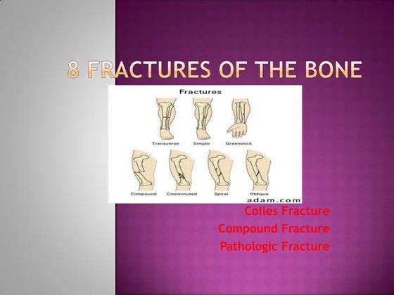 Three Types of Fractures Brett Hartsfield | PPT