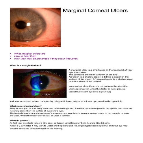 Marginal Corneal Ulcers patient education | DOCX
