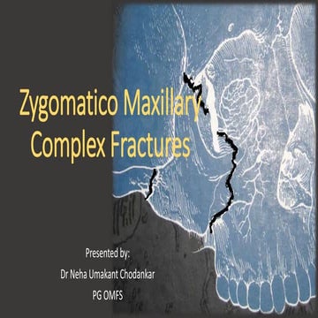 Zygomatico Maxillary Complex Fractures.pptx
