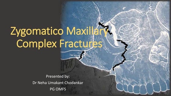 ZYGOMATICOMAXILLARY FRACTURES AND MANAGEMENT | PPT