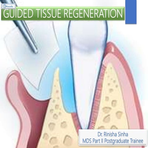 Ridge augmentation | PPTX