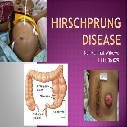 Hirschprung-Disease-ppt.pdf