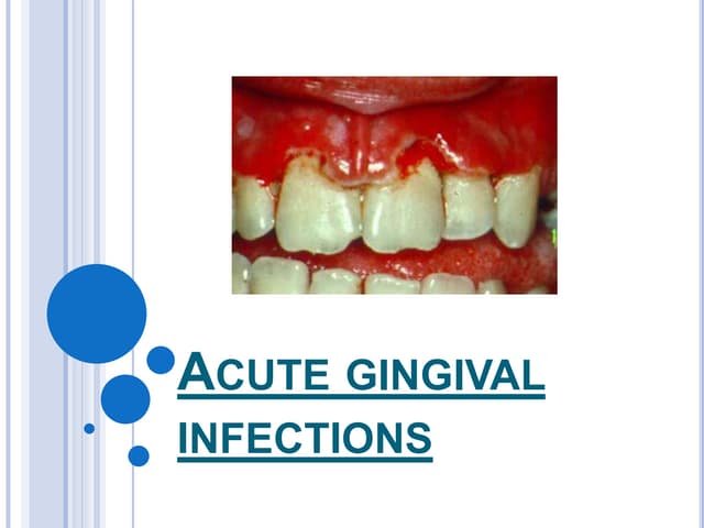Non plaque induced gingival diseases | PPTX
