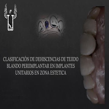 9 CLASIFICACIÓN DE DEHISCENCIAS DE TEJIDO BLANDO PERIIMPLANTAR UNITARIO ...