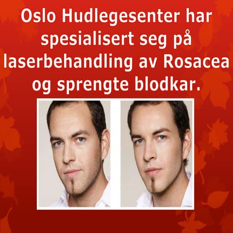 Oslo Hudlegesenter har spesialisert seg på laserbehandling av Rosacea og sprengte blodkar | PPT