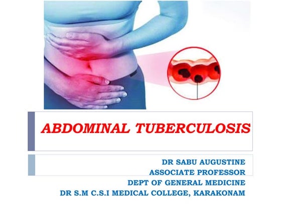 ABDOMINAL TUBERCULOSIS - Practice of medicine | PPTX