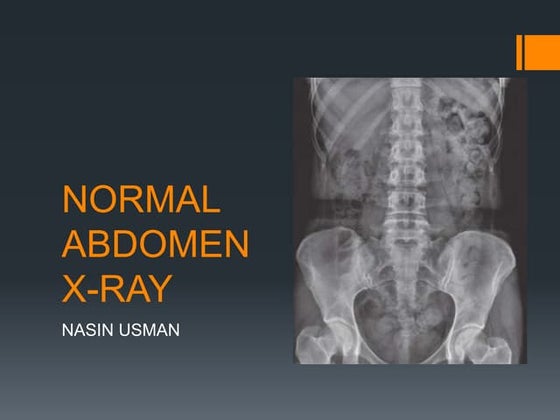 Intravenous Urography Radiology Reference Article Radiopaediaorg